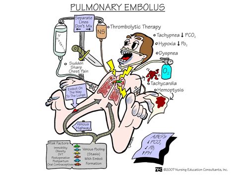 Pulmonary Embolism Lung Sounds Feetdiet
