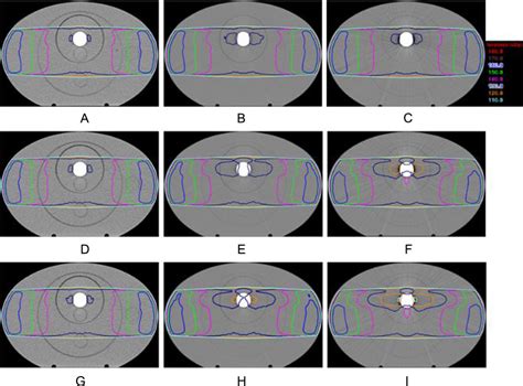 Dose Distribution Map Of Opposed Irradiation Field A 12 Bit