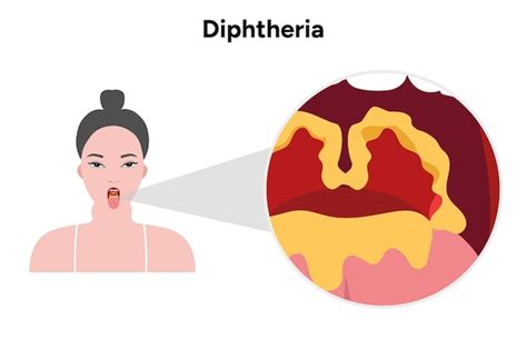 Diphtheria Toxin Vectors And Illustrations For Free Download