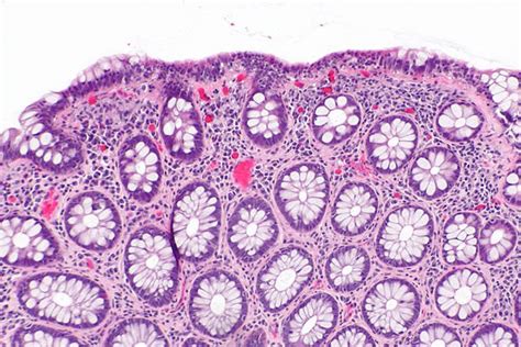 Intraepithelial Lymphocytes Libre Pathology