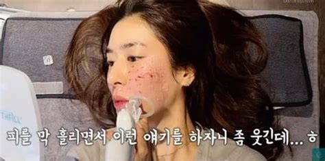 피부 시술도 셀프로 ‘주진모 아내 민혜연 “피 흘리면서 얘기 하자니~” 세계일보