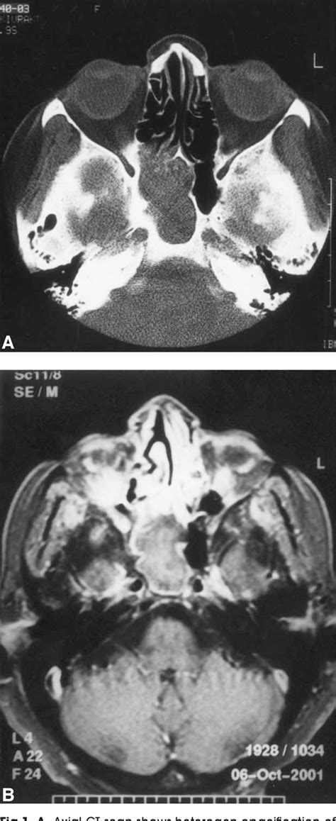 Figure 1 From Indolent Mucormycosis Of The Sphenoid Sinus Semantic
