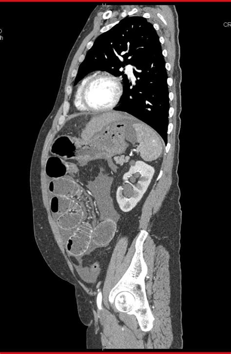 Small Bowel Obstruction Sbo With Ischemic Bowel And Midline
