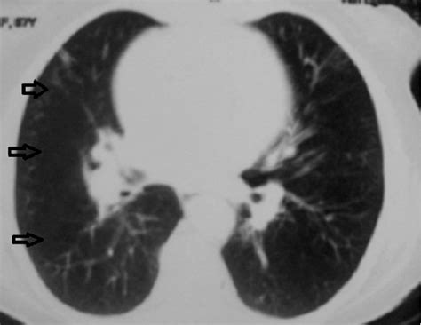 Hyperlucency On Thoracic High Resolution Computerized Tomography