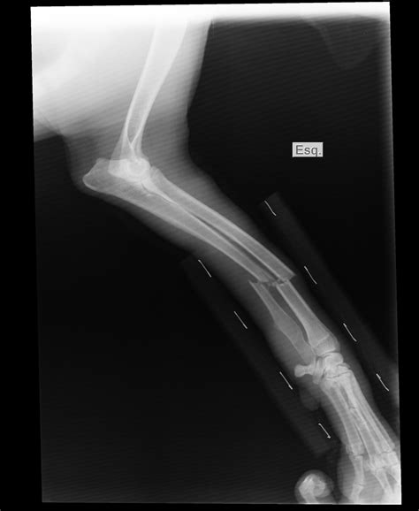 Broken Arm X Ray