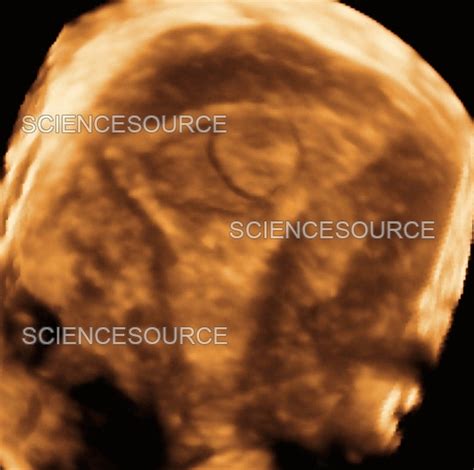 Endometrial Polyp Ultrasound Scan Stock Image Science Source Images