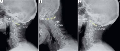 Lateral Neutral A Flexion B And Extension C Radiographs