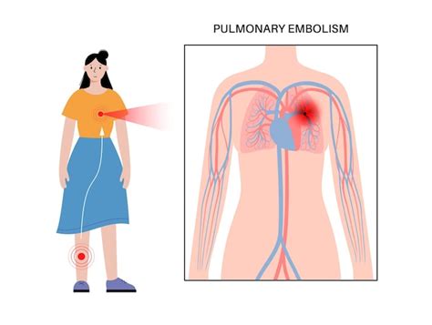 Premium Vector Pulmonary Embolism Disease