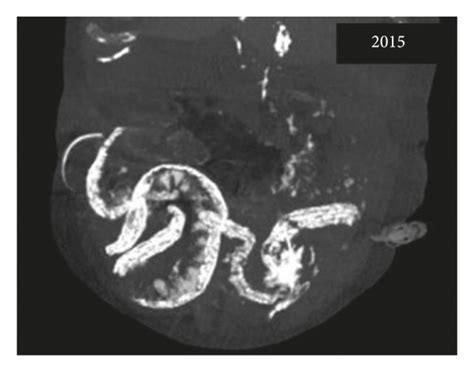 Abdominal Ct Scans Of The Patient In 2009 A Showing Mild Linear