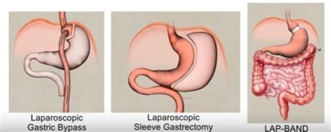 Gastric Bypass Surgeries Gut Microbiota Flashcards Quizlet