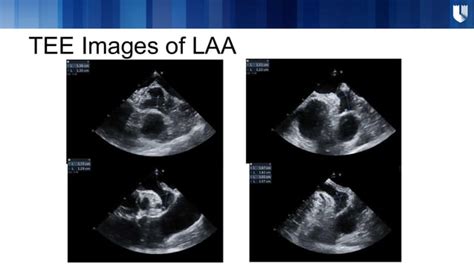 Update On Percutaneous Left Atrial Appendage Occlusion Ppt