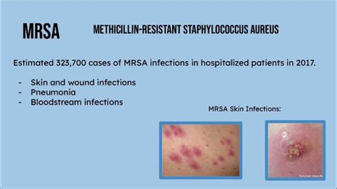 Antibiotic Resistance Superbugs Youtube