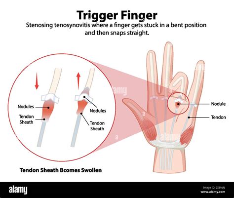 Diagram Explaining Trigger Finger Condition And Symptoms Stock Vector Image And Art Alamy