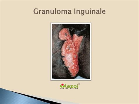 Ppt Granuloma Inguinale Powerpoint Presentation Free Download Id