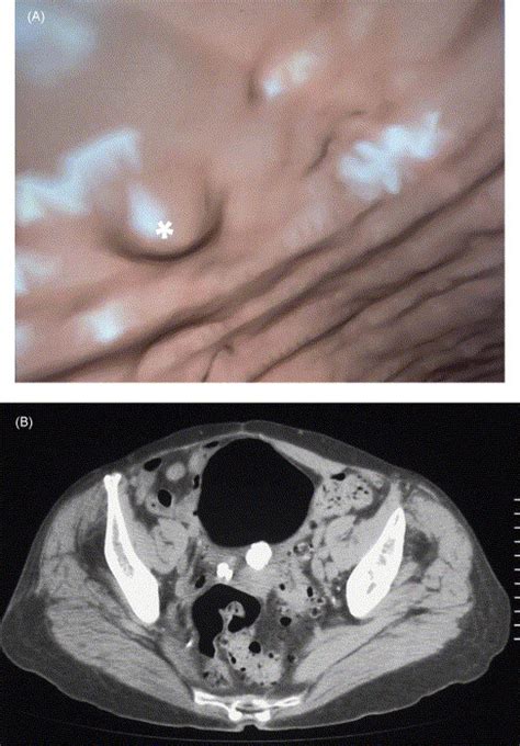 Ct Cystography And Virtual Cystoscopy In The Assessment Of New And Recurrent Bladder Neoplasms