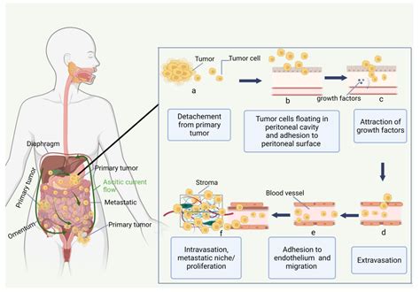 Primary Peritoneal Cancer Symptoms