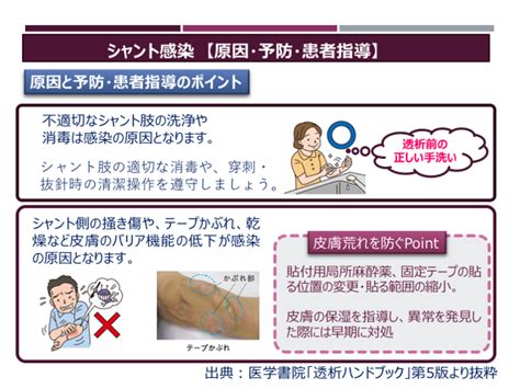 バスキュラーアクセス（シャント）｜plus Chugai 中外製薬医療関係者向けサイト（看護師・保健師向け）