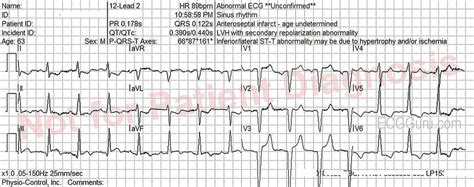 Inferior Wall Mi In A Patient With Left Bundle Branch Block Ecg Guru Instructor Resources