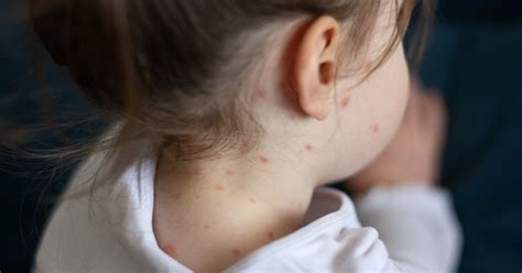 Measles Rash Pictures Common Signs And Tips To Identify Measles
