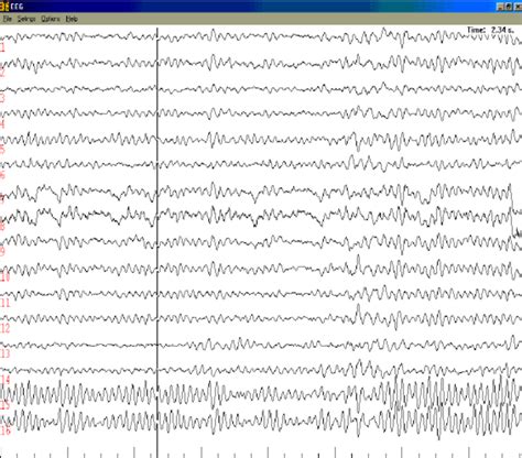 Standard Waveform View On Eeg Signal As Default Vmd Download