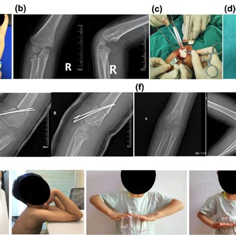Radiographs And Comparison Between Preoperative And Intraoperative