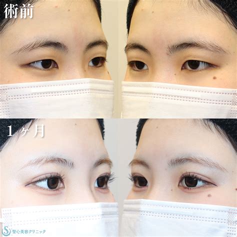 【20代女性・埋没法で目を大きく華やかに】二重術（埋没法）：マイクロメソッドα（1ヶ月後） 症例写真 美容整形、美容外科なら聖心美容