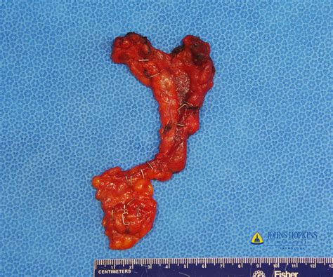 Oriented Neck Dissection Surgical Pathology Photo Website