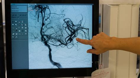What Are The Different Types Of Blood Clots