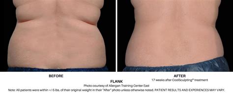 How To Get Rid Of Love Handles Fat Reduction Coolsculpting