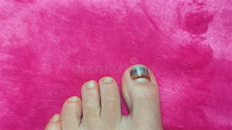 Fungal Infection Has Affected The Toenail Of A Young Girl Close Up Of