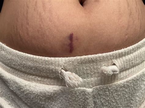 Bruising On Injection Site R Liraglutide