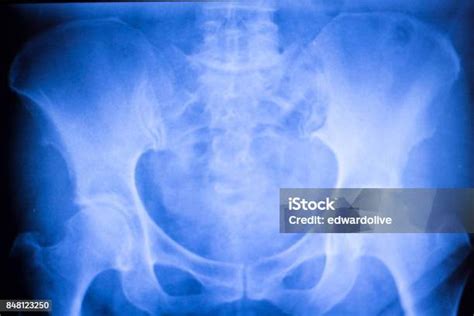 Hasil Tes Pemindaian Xray Sendi Pinggul Tulang Belakang Dan Panggul