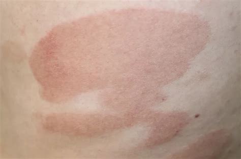 Ketahui 2 Jenis Eritema Multiformis