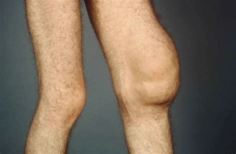 Knee Joint Effusion Mobile Physiotherapy Clinic