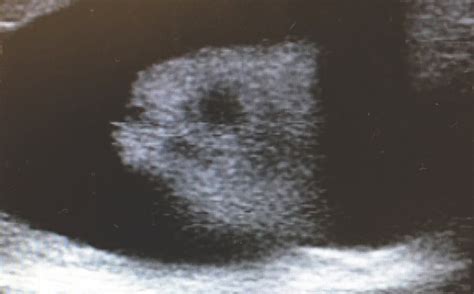 Swollen Lymph Nodes In Male Groin Area