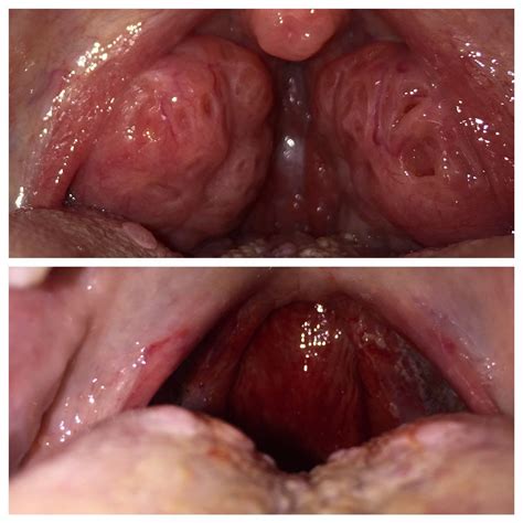 Tonsillectomy Before And After Rsurgery