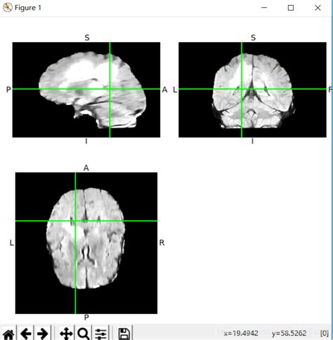 如何读取nifti格式图像（nii文件）nii格式nifti打不开 Csdn博客