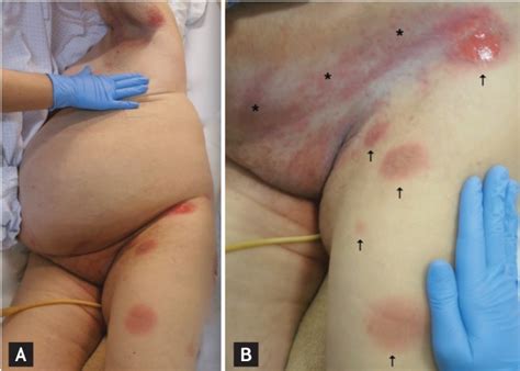 Ciprofloxacin An Uncommon Drug Reaction To A Commonly Used Drug Pmc