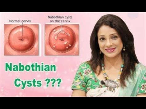 What Are Nabothian Cyst Youtube
