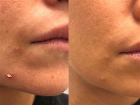 How To Hide A Pimple Without Using Makeup Saubhaya Makeup