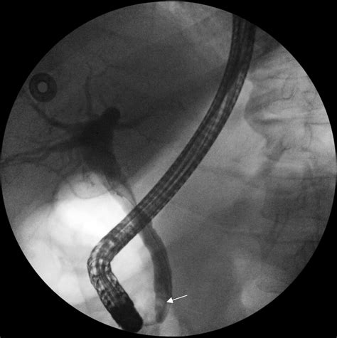 ERCP Image NucsRadiology Com