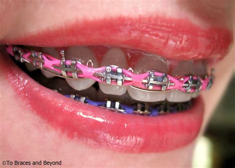 Cute Braces Colors For Teens Girls Braces Colors Power Chain Braces