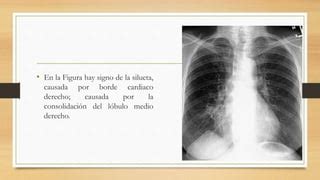 Signos De Colapso Lobar Y Pulmonar Pptx