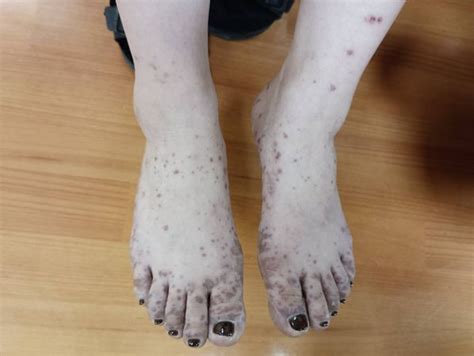手腳狂冒紅疹！2寶媽竟罹患腸病毒 小兒科醫提醒：還在大流行 Ettoday生活新聞 Ettoday新聞雲