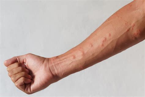 Delving Into Hailey Hailey Disease From Genetics To Triggers Bldg Active