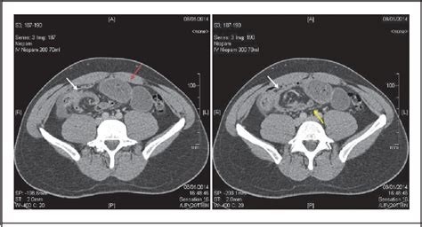 Figure 3 From Laparoscopic Management Of Terminal Ileal Volvulus Caused