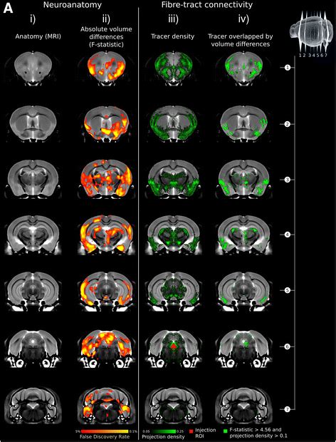 Association Between The Dorsal Raphe Nucleus Drn Fiber Tract Download Scientific Diagram