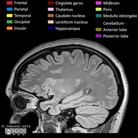 Brain Lobes Annotated Mri Radiopaedia Sagittal Nc Commons