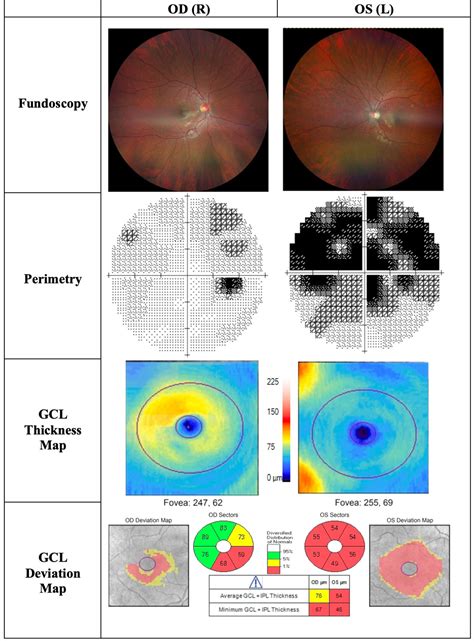 Affects Of Leber Hereditary Optic Neuropathy At Lucas Angas Blog