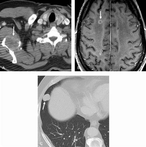 Spectrum Of Hematogenous Metastases A Axial Contrast Enhanced Ct In